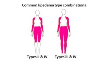 Classificazione, tipizzazione e stadiazione - LIO Lipedema Italia ...